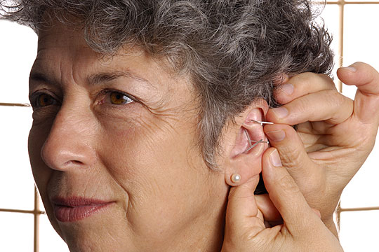 Try Acupuncture Near You - Here’s Why